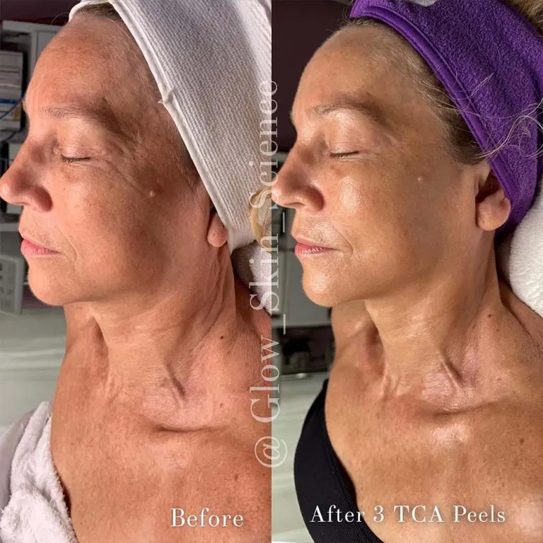 TCA Peel: Everything You Need to Know Before Booking