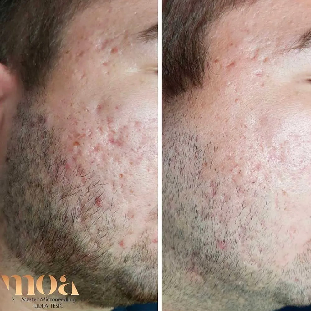 Microneedling Depth Guide Through Areas & Concerns Microneedling Depth Guide Through Areas & Concerns