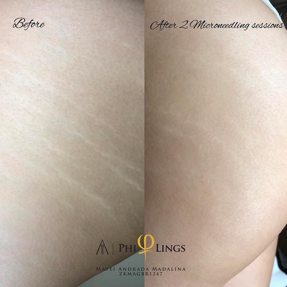 Microneedling Depth Guide Through Areas & Concerns Microneedling Depth Guide Through Areas & Concerns
