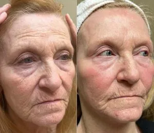 CO2 Laser Resurfacing: Types, Effects, Cost, Aftercare