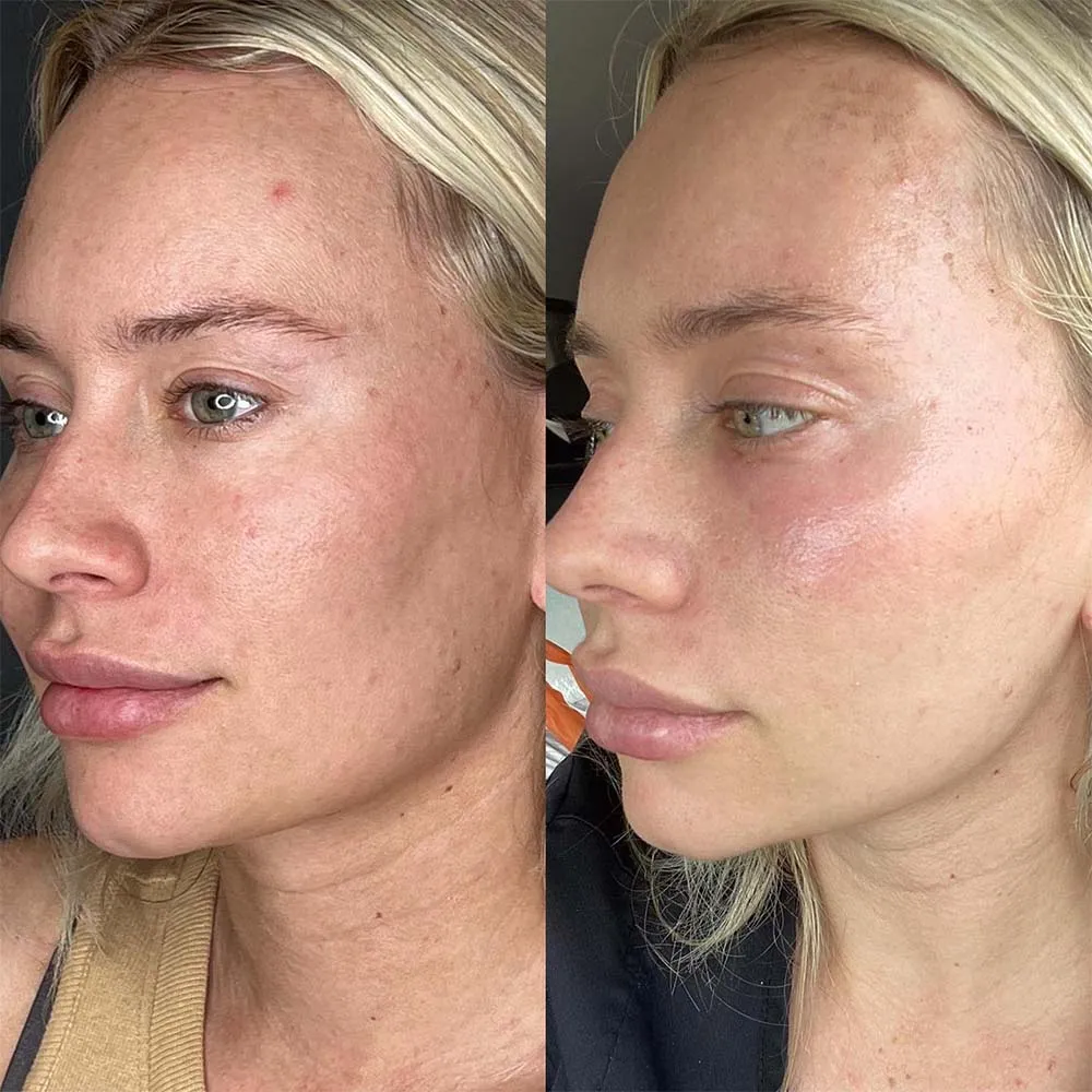 Laser Skin Resurfacing: Types, Effects, Risks, Cost Laser Skin Resurfacing: Types, Effects, Risks, Cost