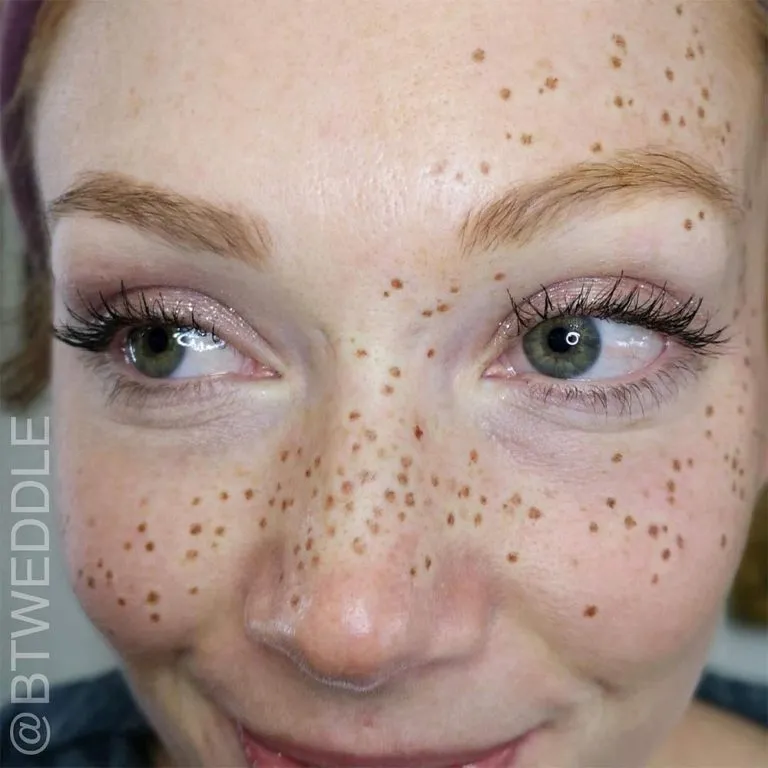 Why Has Your Freckle Tattoo Gone Wrong & How to Fix It?