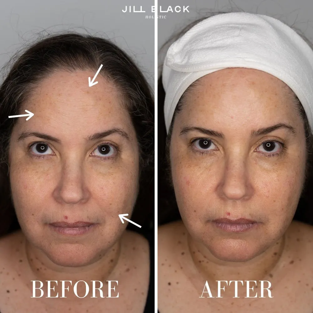 Microcurrent Facial - All You Need to Know Microcurrent Facial - All You Need to Know