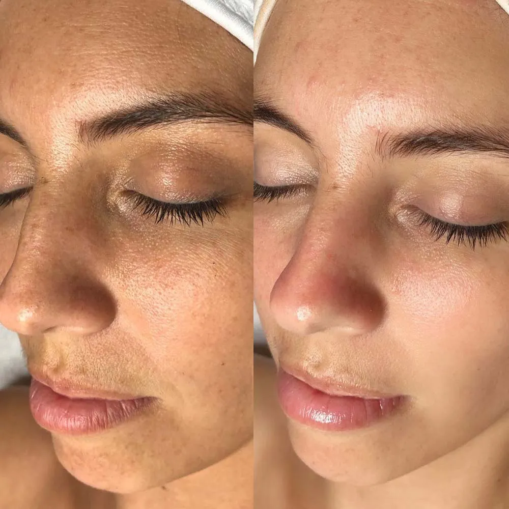 The Ultimate Guide to Oxygen Facial Treatment The Ultimate Guide to Oxygen Facial Treatment