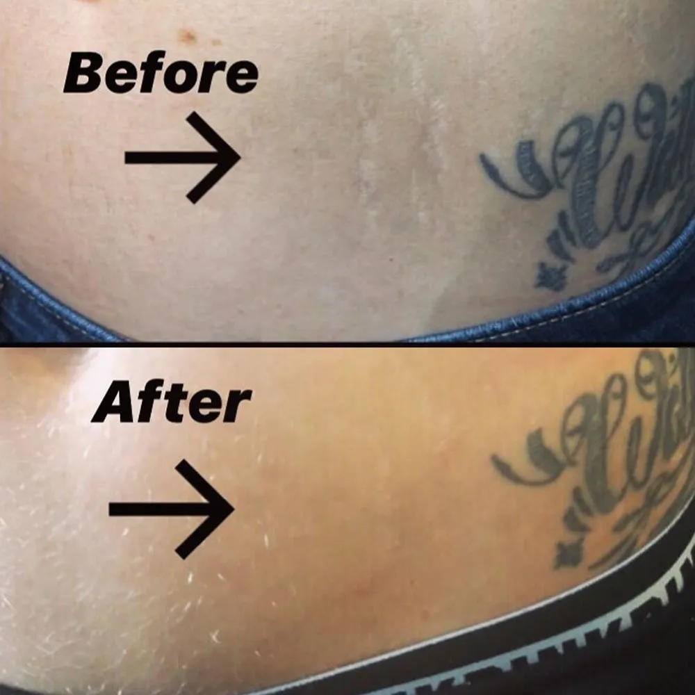 Plasma Pen for Stretch Marks: Does It Work + FAQ