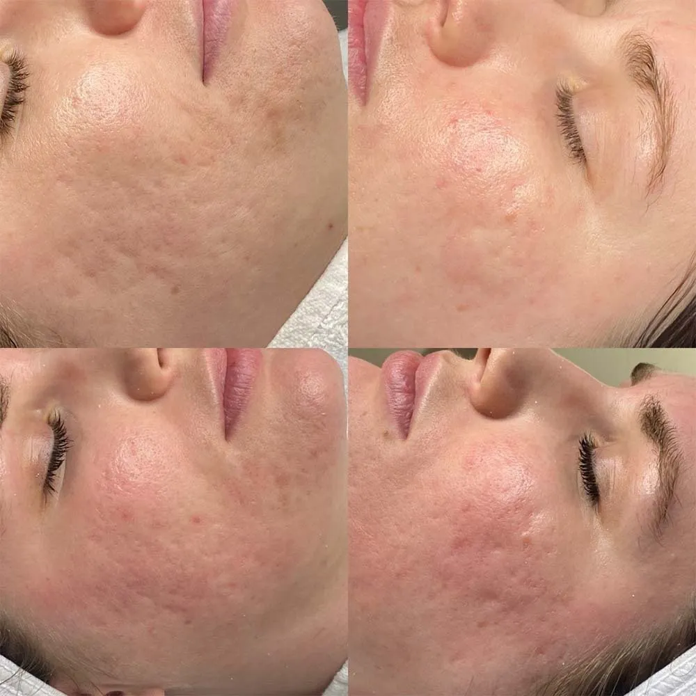 Mandelic Acid Peel: Benefits, Safety, Costs & Side Effects