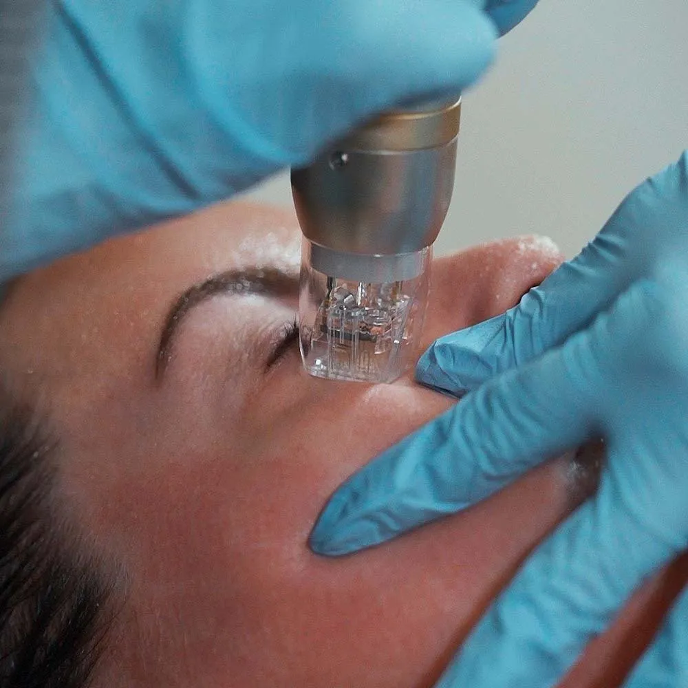 Microneedling for Eyebrows - Boost Your Brows Naturally
