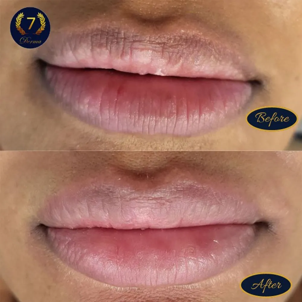 Laser Lip Lightening: Effects, Cost, Risks